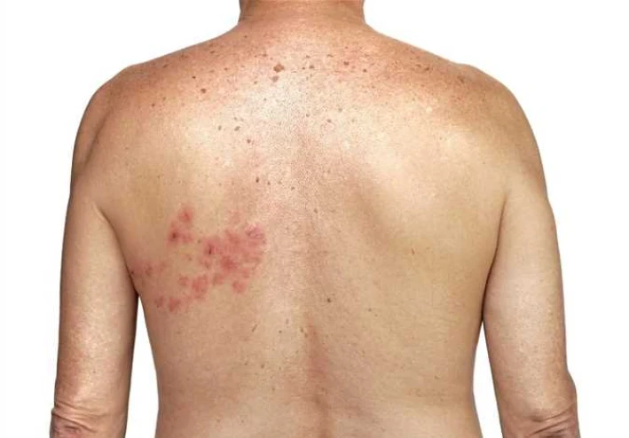 أموالي منصة الناشرين - Shingles: A hidden pain that may haunt you after ...